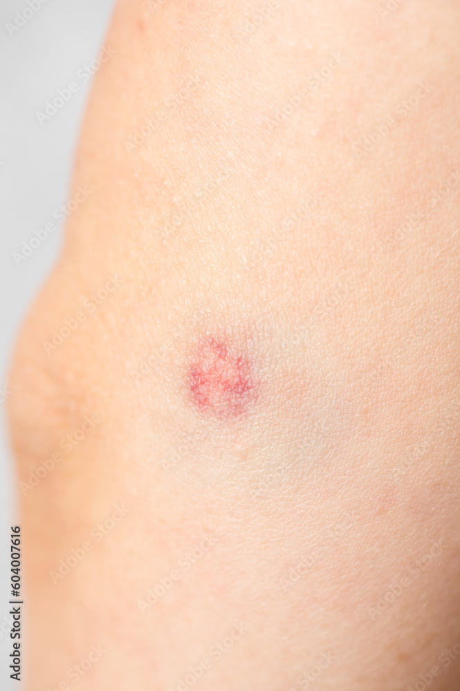 big bruise on the girl's skin close up. Skin hematoma. Purple wound ...