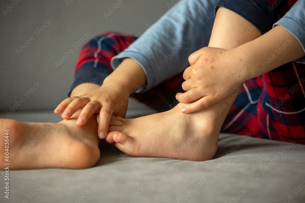Child with skin rash, roseola. Hand-foot-and-mouth disease. Enterovirus ...