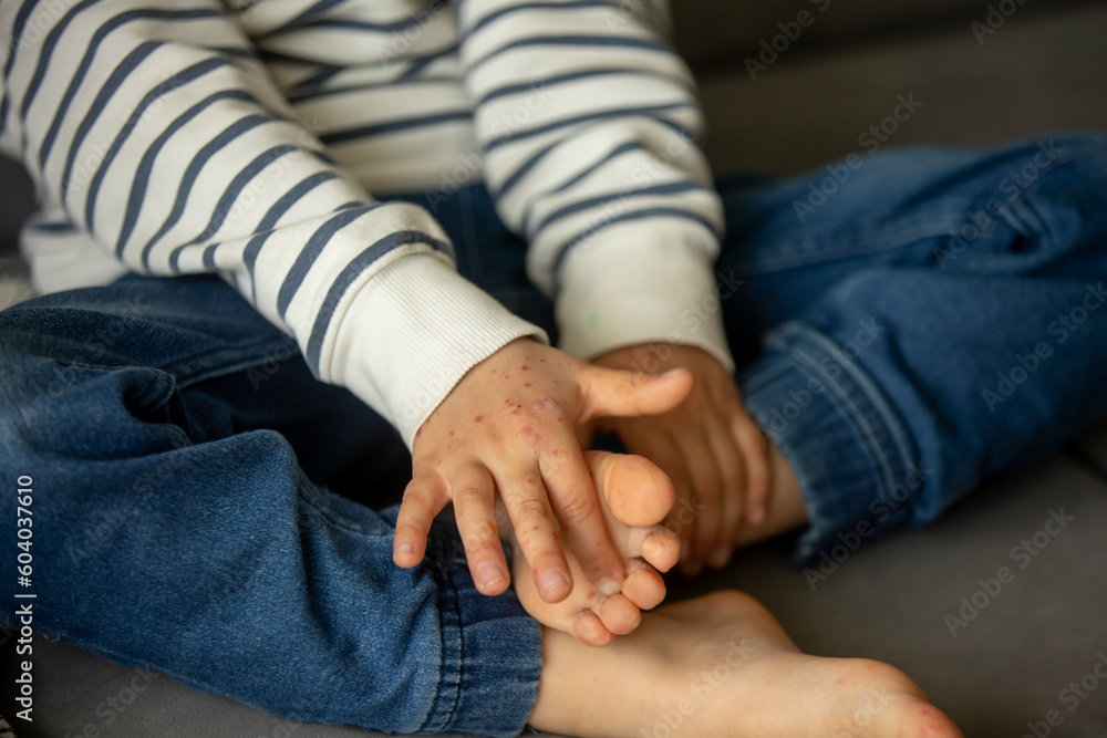 Child with skin rash, roseola. Hand-foot-and-mouth disease. Enterovirus ...