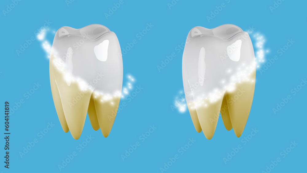 3d tooth whitening hygiene icon. Dental plaque cleaning with laser ...