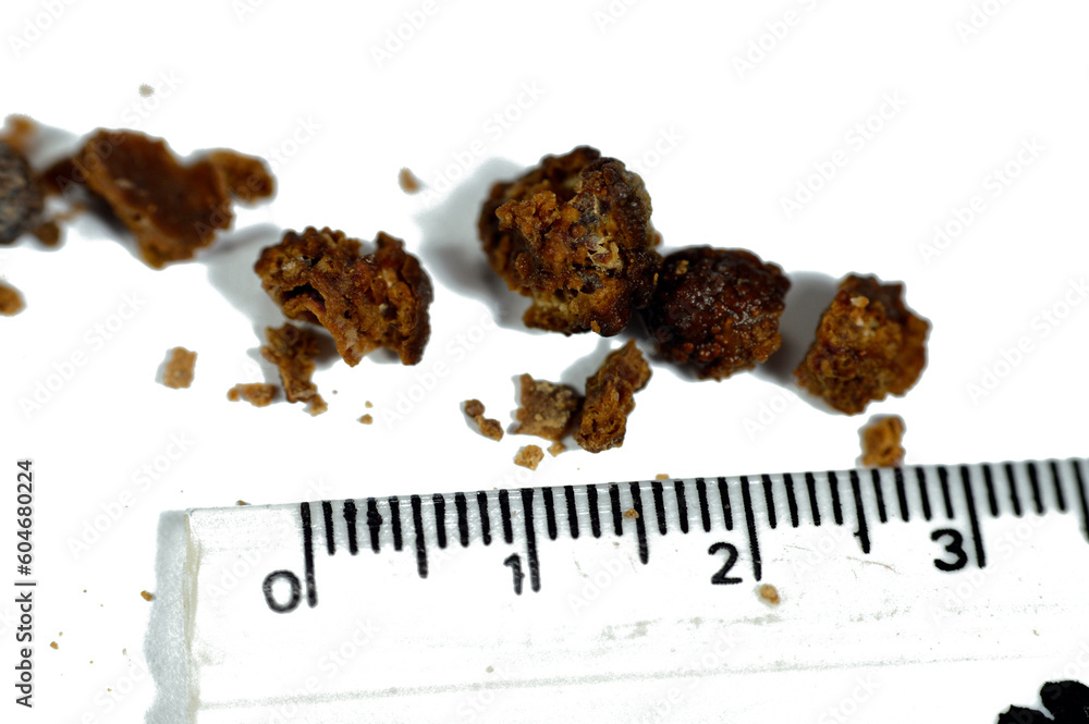 Nephrolithiasis, irregular brown kidney stones (renal calculus or ...