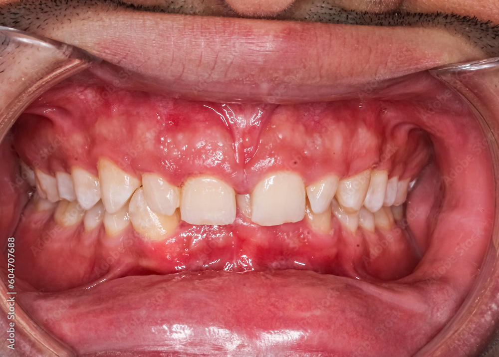 Dental orthodontics patient, frontal view of maxillary and mandibular ...