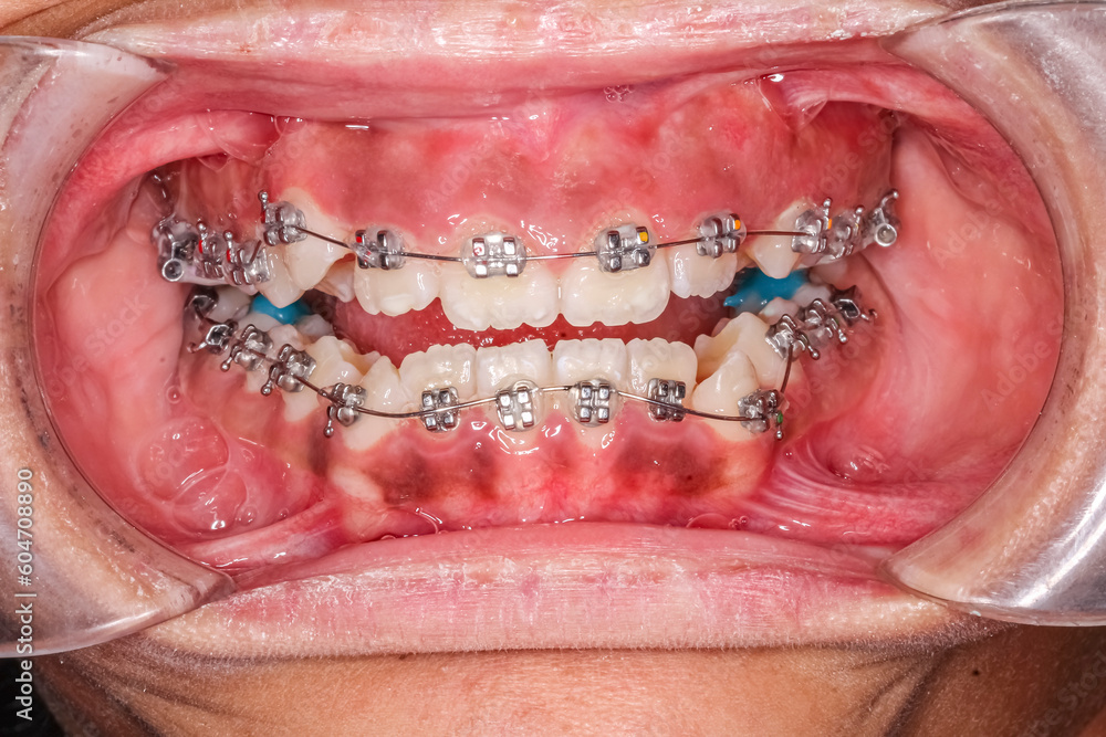 Dental orthodontic braces for orthodontics teeth alignment treatment ...