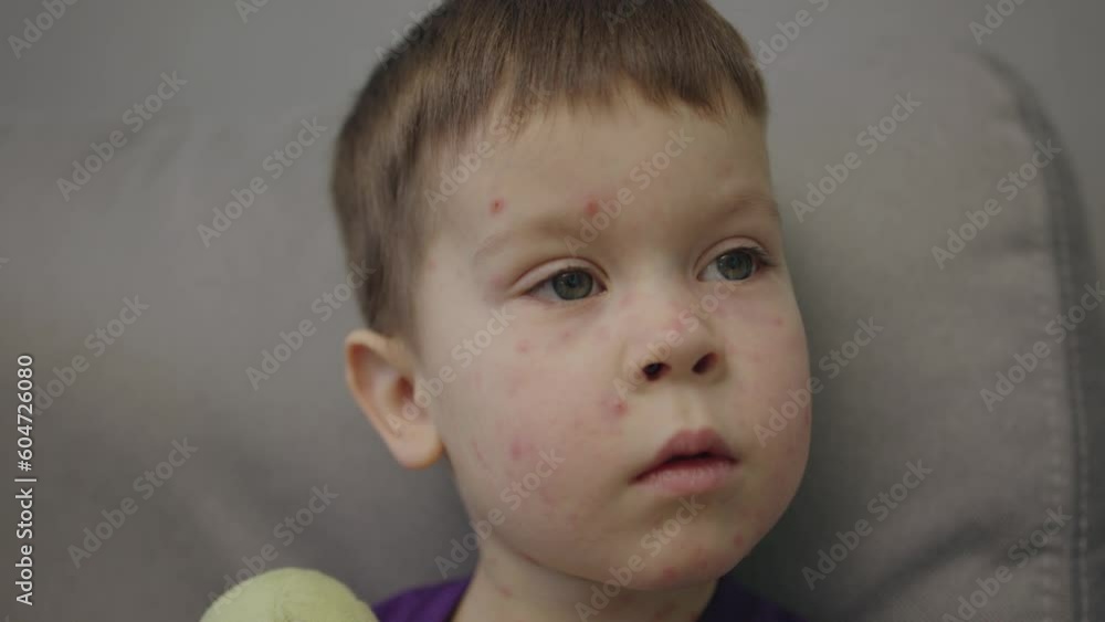 baby child little kid chicken pox disease face red pimples symptoms boy ...