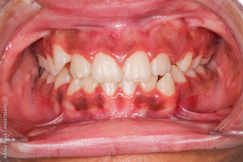 Frontal view of dental maxilla and mandibular arches in occlusion with ...