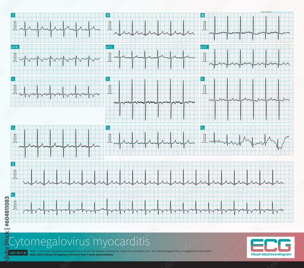 Photo & Art Print An 11-month-old boy with frequent vomiting, syncope ...