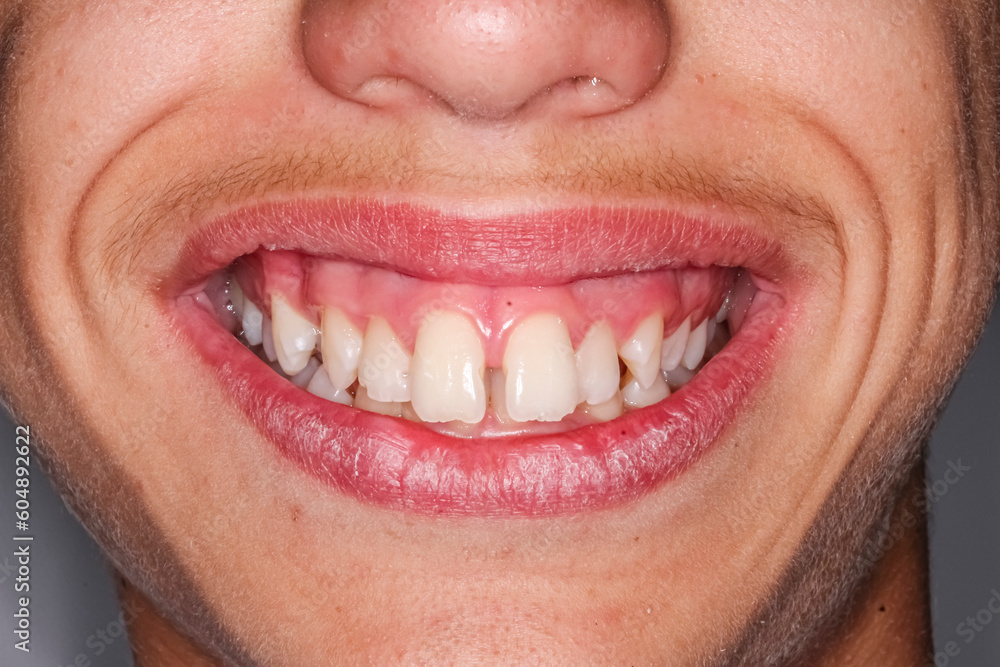 Dental maxillary and mandibular arches in occlusion with biting teeth ...