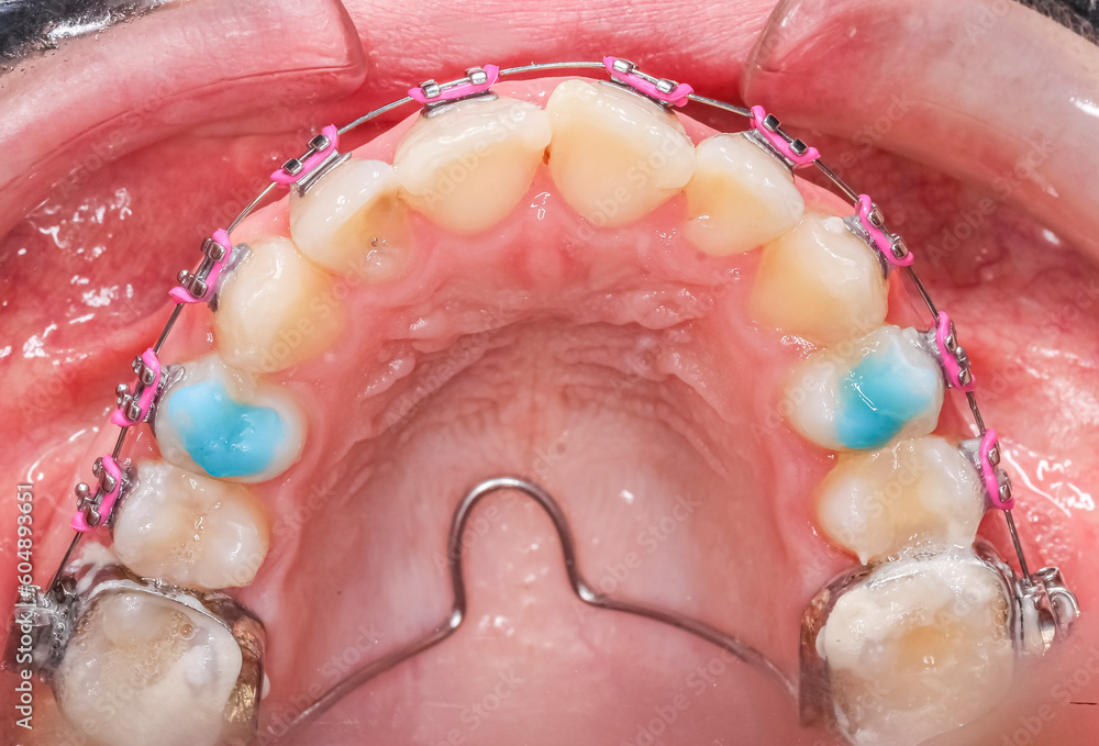 NiTi palatal expander metallic arch wire sealed with sealing cement in ...