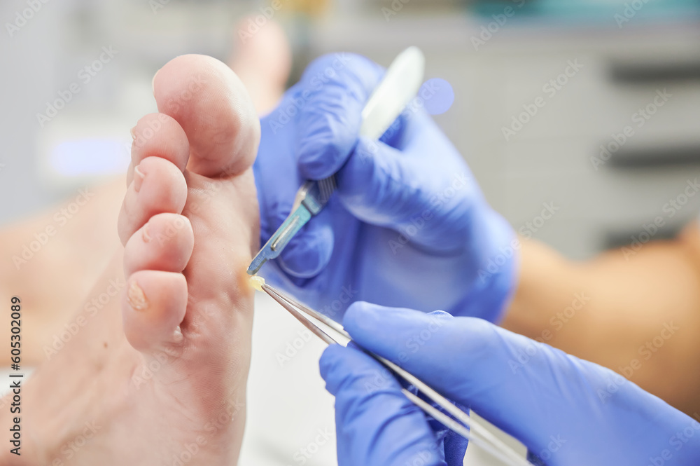 Podiatrist doctor checks the feet of a patient who needs to remove a ...