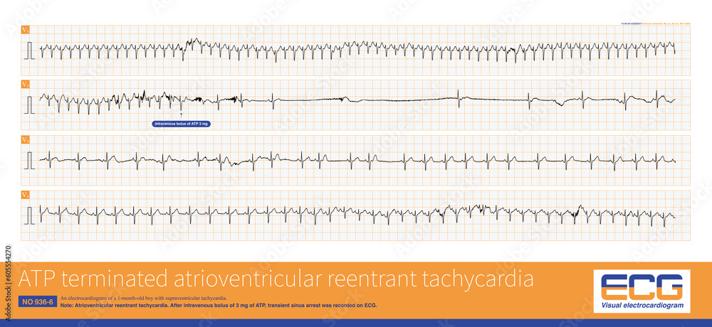 In a 1-month-old boy with an onset of atrioventricular re-entrant ...