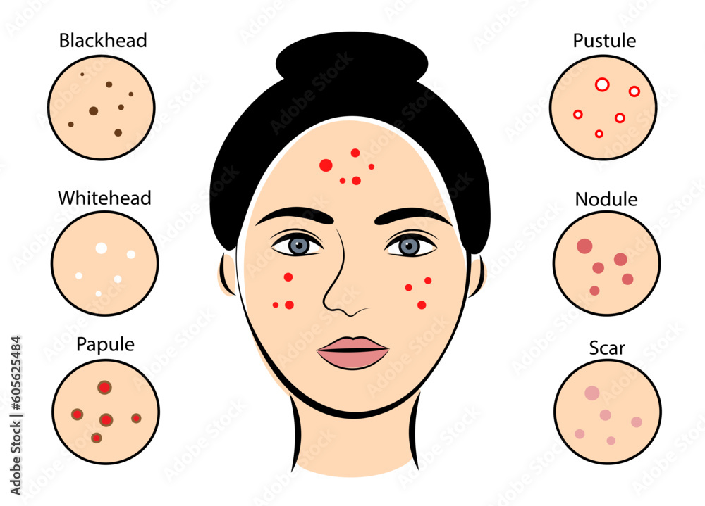 Face of a girl with pimples on a white background. Acne stages. Vector ...