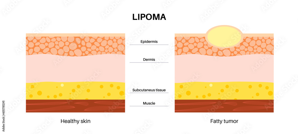 Lipoma medical poster Stock Vector | Adobe Stock