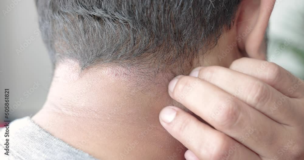 Close-up man scratches sick dry flaky skin and itching. Disease about ...