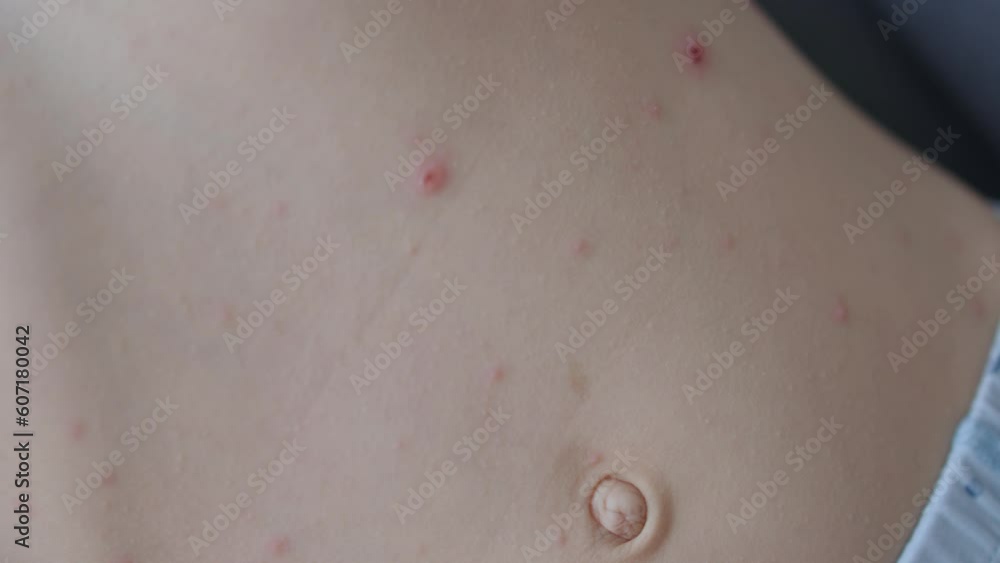 chickenpox rash blisters filled liquid on child skin back stomach leg ...