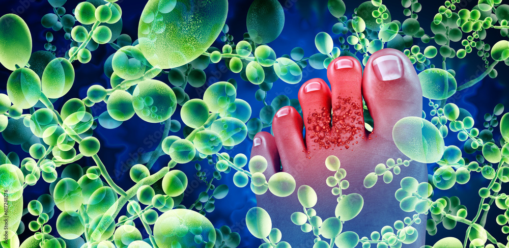 Poster Foot Fungal Infection and feet fungus or contamination of fungi ...