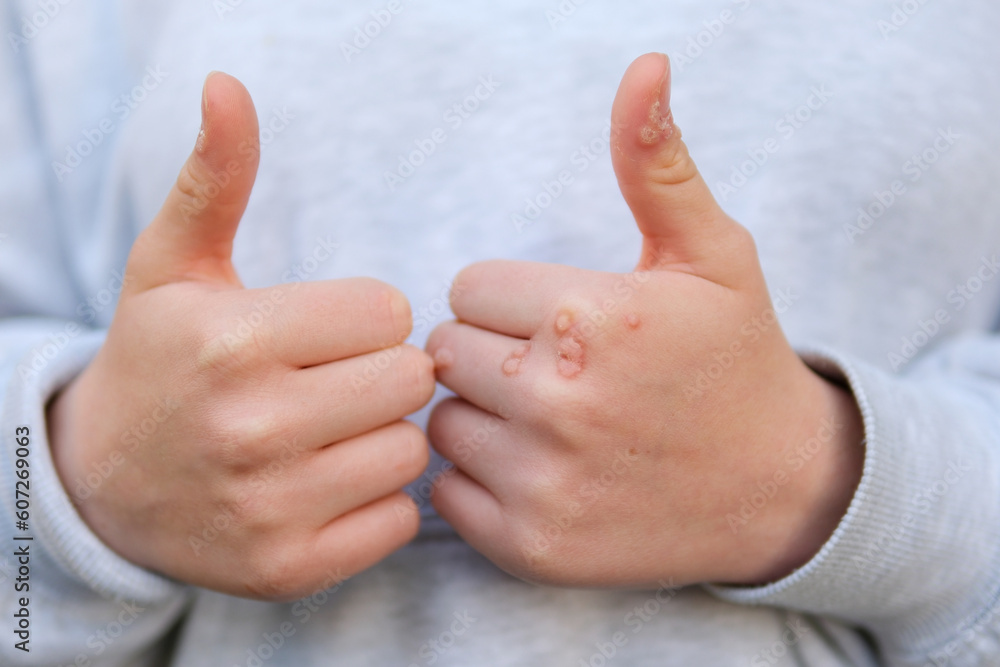 Hand with wart man skin closeup hands of young teenage girl are strewn ...