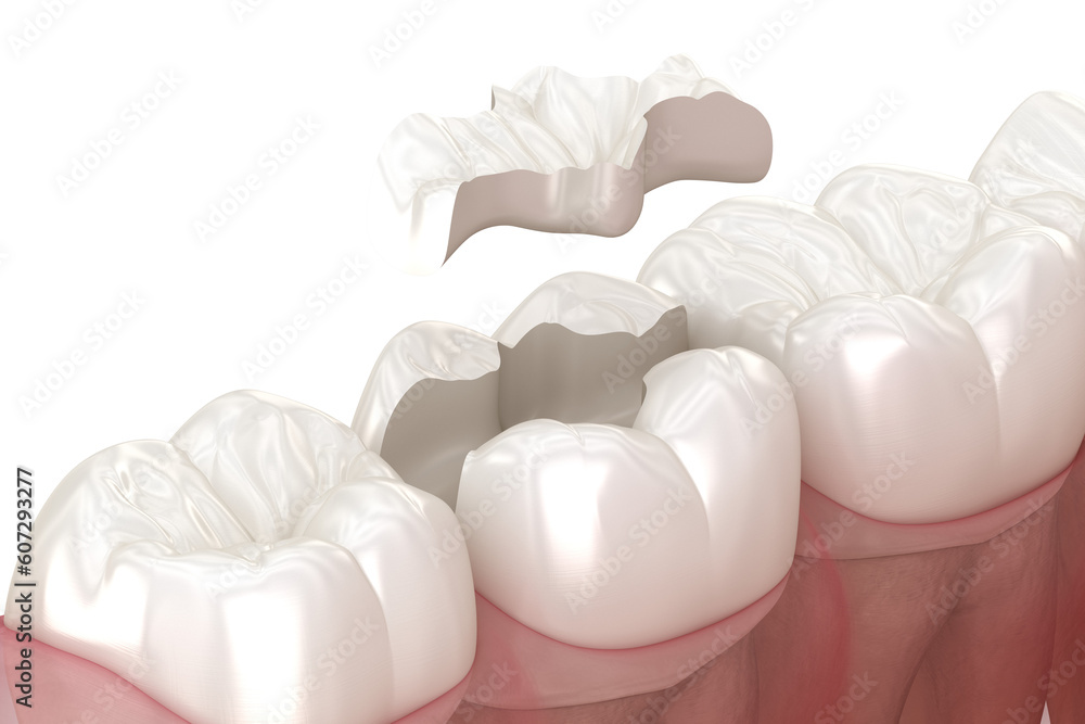 Onlay ceramic crown fixation over tooth. 3D illustration with ...