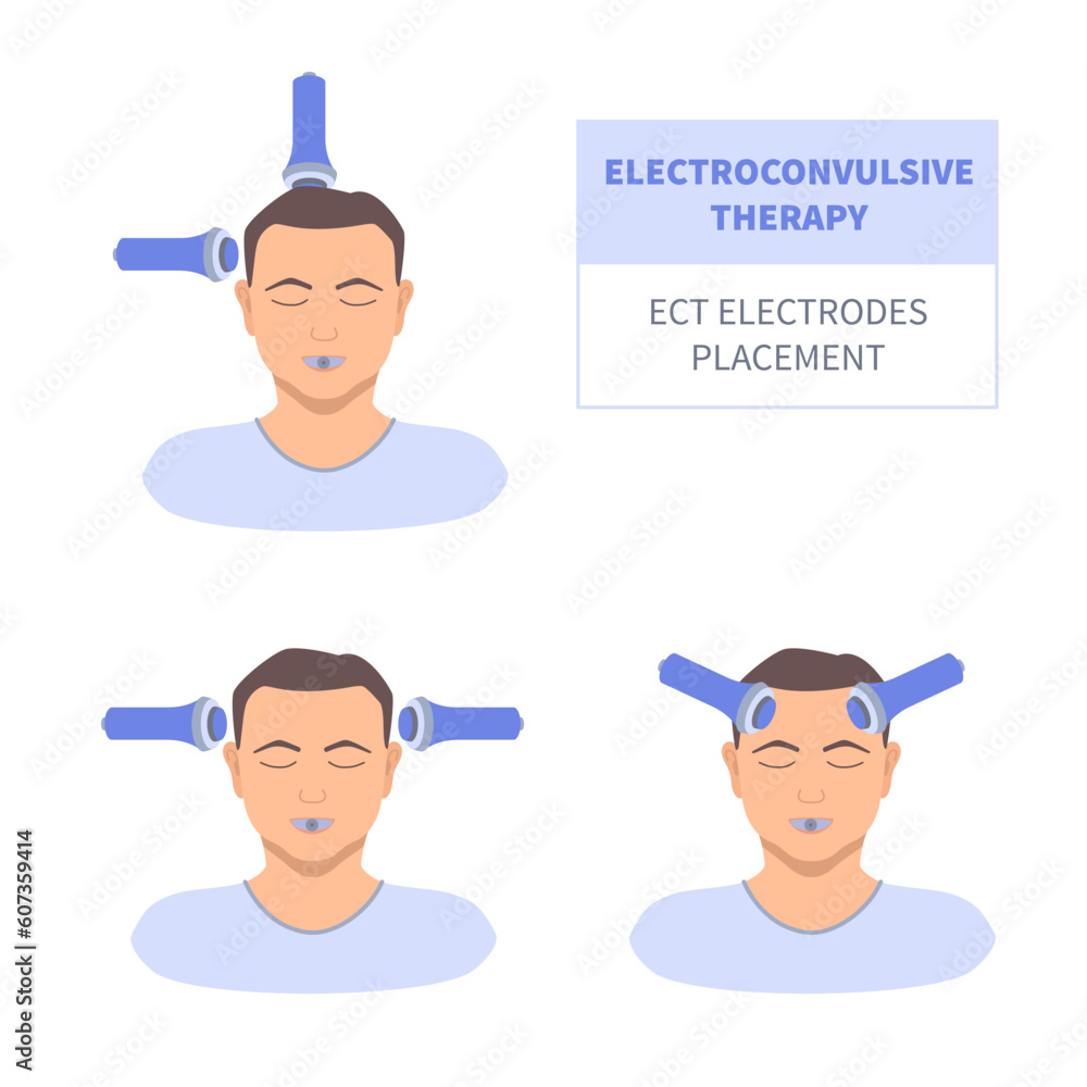 Electroconvulsive therapy for severe depression and schizophrenia ...