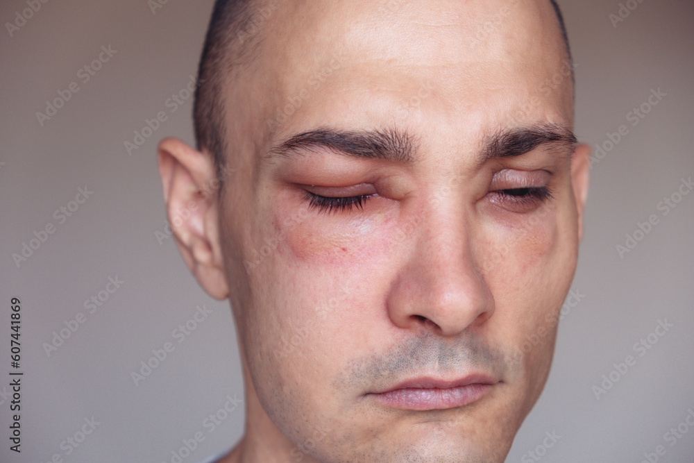 Caucasian man has angioedema around the eyes caused by allergic ...