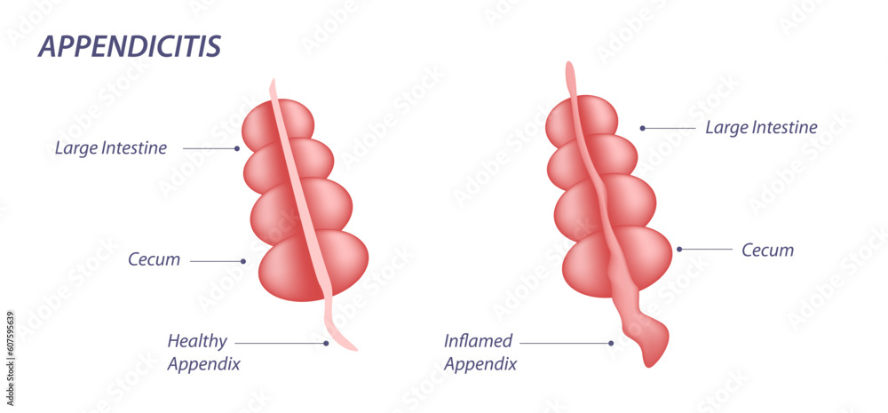 Appendicitis is an inflammation of the appendix. Appendicitis ...