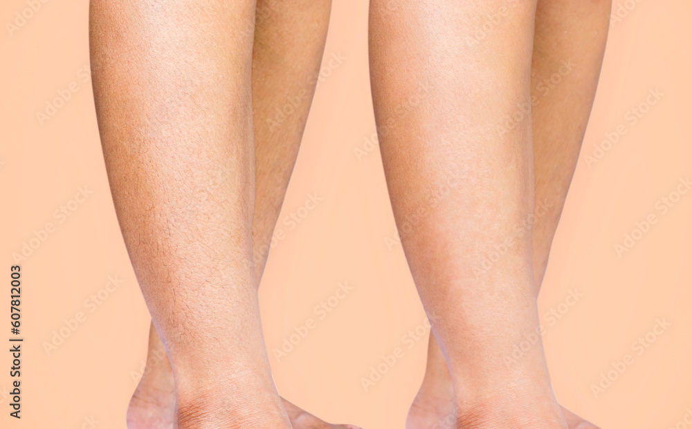 Image compare woman legs result before and after leg hairs removal ...