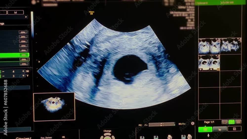 Ultrasound of the baby in the womb 5 weeks 5 days. Yolk and pregnancy ...