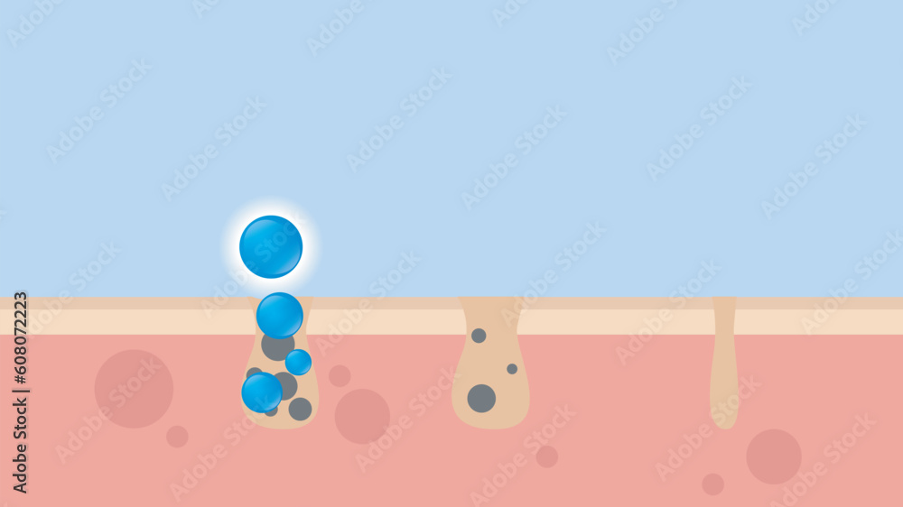 Acne Pimple treatment inflammation associated with pimples. On a blue ...