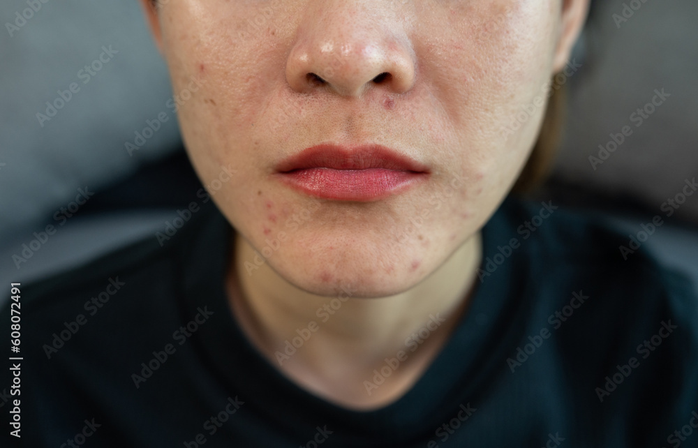 Foto de Cropped shot of lower face of woman with acne problem. Acne is ...