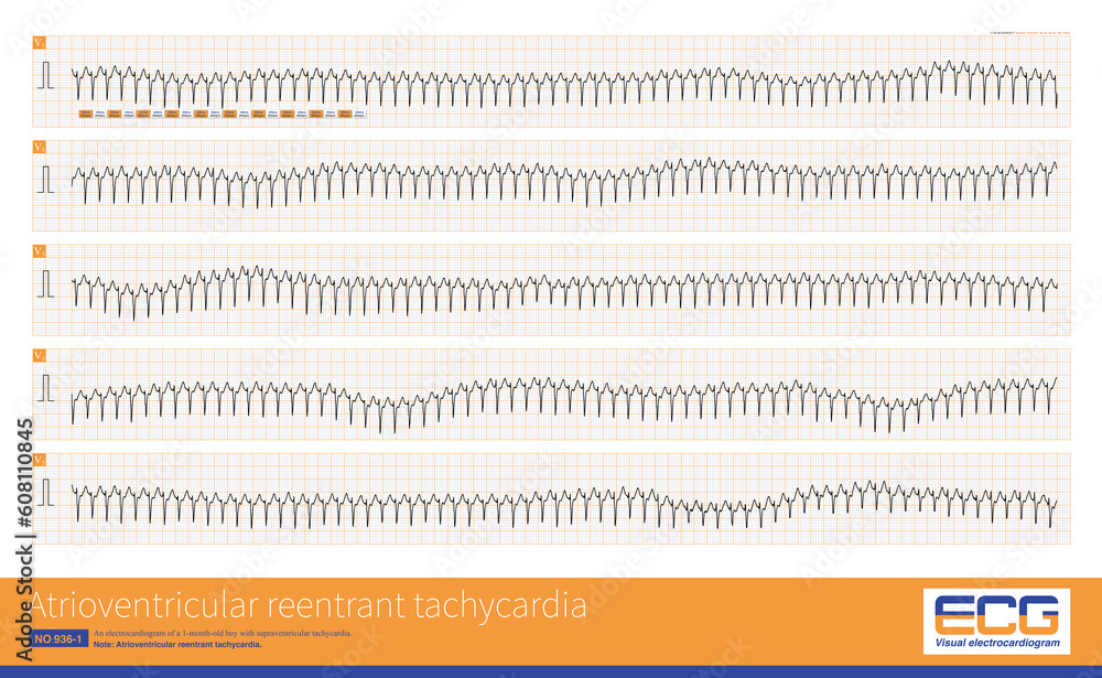 A 1-month-old boy with recurrent supraventricular tachycardia ...
