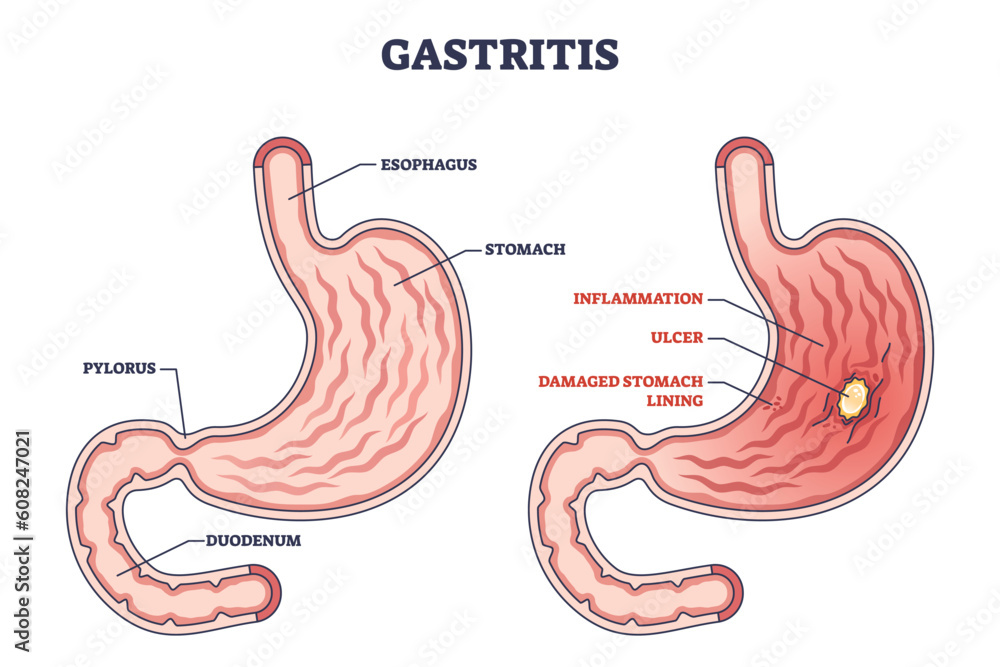 Gastritis As Stomach Lining Inflammation Illness And Disease Outline Diagram Labeled