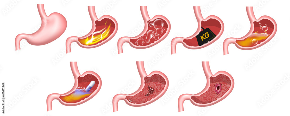 Human stomach problems, Gastrointestinal diseases. Common Digestive ...