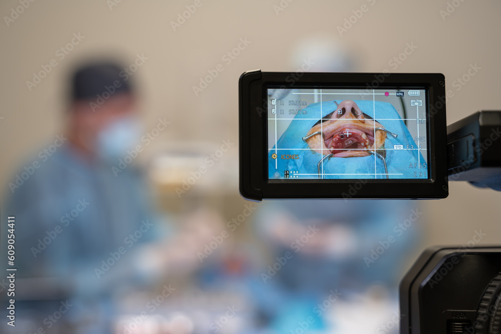 écran d'une caméra en tournage d'une opération dentaire avec implant ...