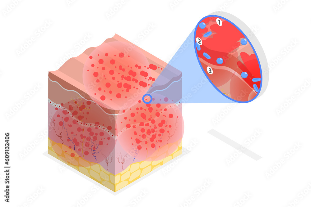3d Isometric Flat Conceptual Illustration Of Atopic Dermatitis Stock