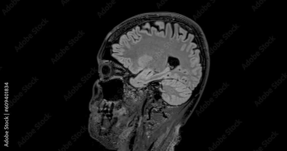 MRI of the brain sagittal t2W flair fatsuppresion for diagnosis brain ...
