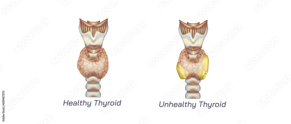 hypothyroidism vs hyperthyroidism. healthy and unhealthy thyroid test ...