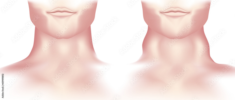 hypothyroidism vs hyperthyroidism. healthy and unhealthy thyroid test ...