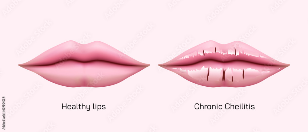 Chronic angular cheilitis problem. Dry chapped lips vector illustration ...