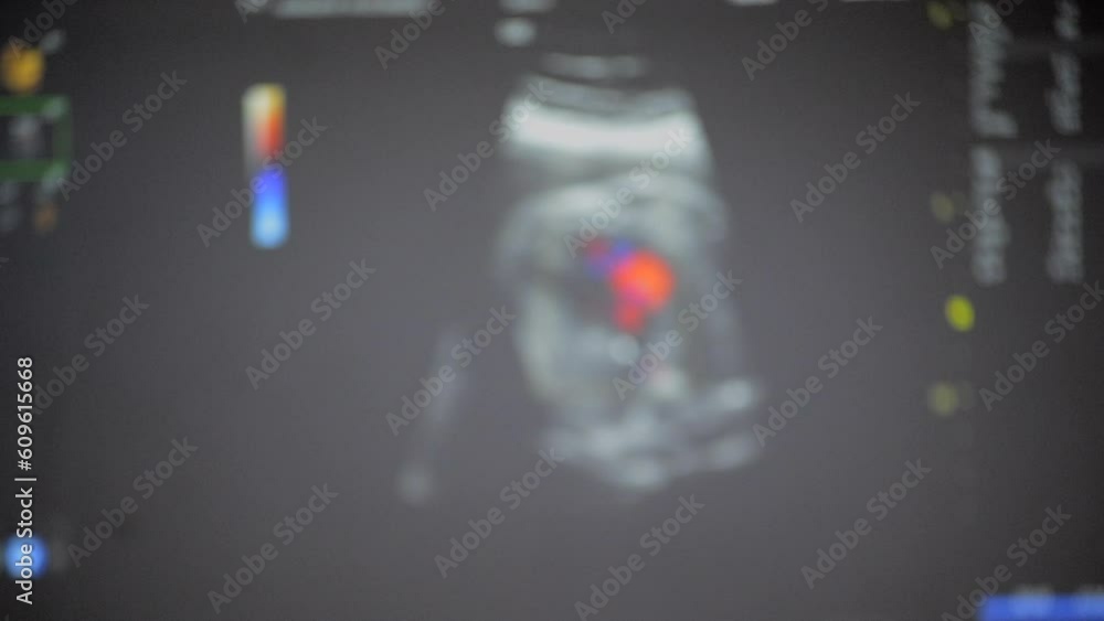 Blurred background. Utrasound image on monitor. Ultrasound Scan display ...