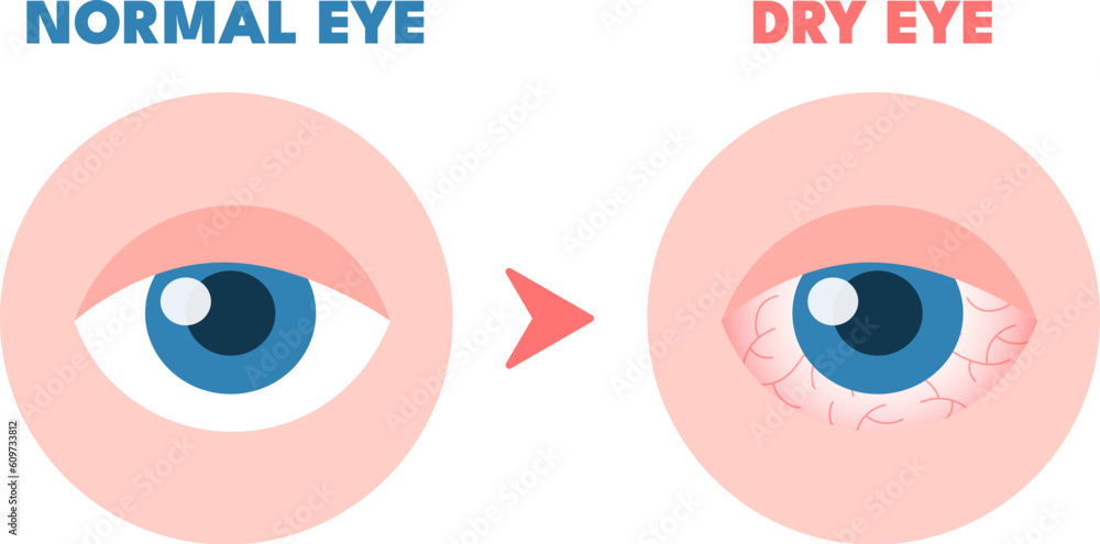 Dry eyes. Healthy unhealthy red eye, driing astonished redness ...