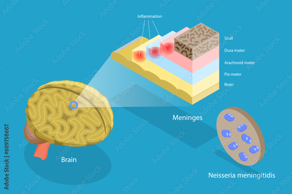 3D Isometric Flat Vector Conceptual Illustration of Meningitis, Human ...