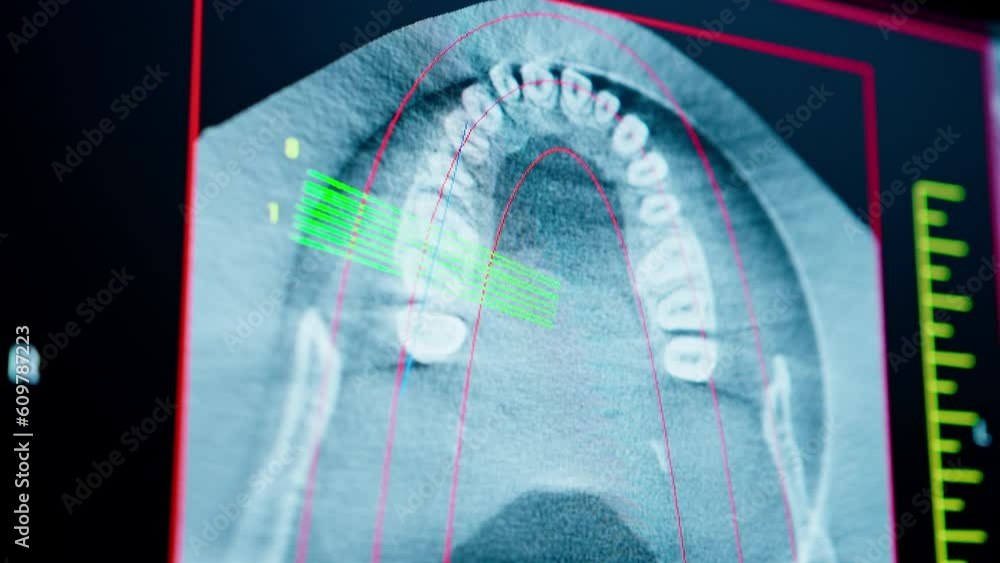 scanning of teeth on an X-ray image of a patient's jaw on a computer ...