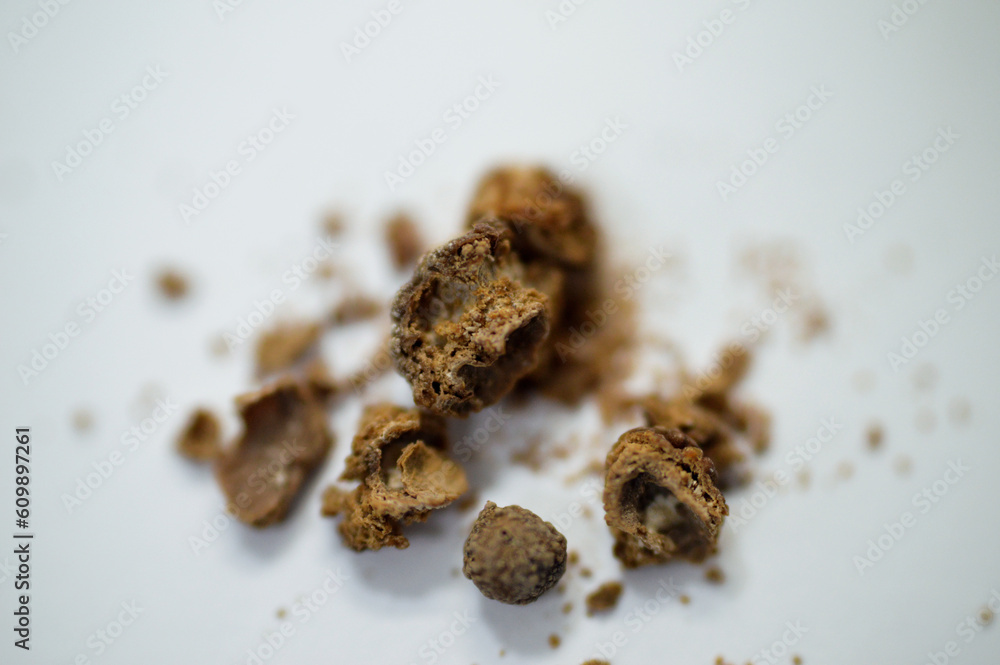 Nephrolithiasis, irregular brown kidney stones (renal calculus or ...