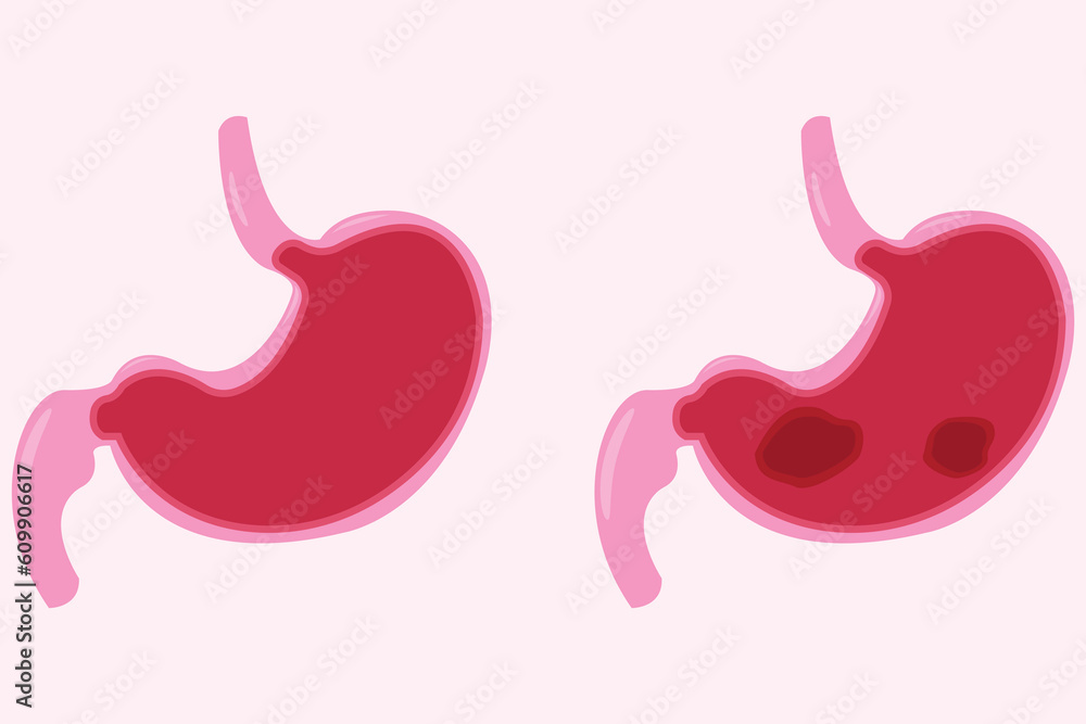 Stomach icon set, cartoon vector illustration. cross section of normal ...