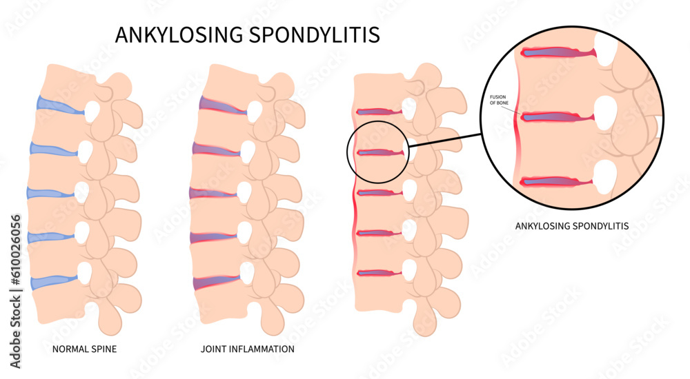fused spine disk of kyphosis lordosis or scoliosis kyphoscoliosis ...