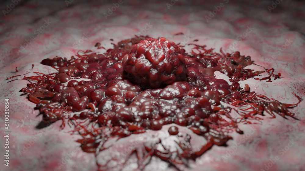 Cancer cell growth uncontrollably over tissue, Tumor infection cells ...