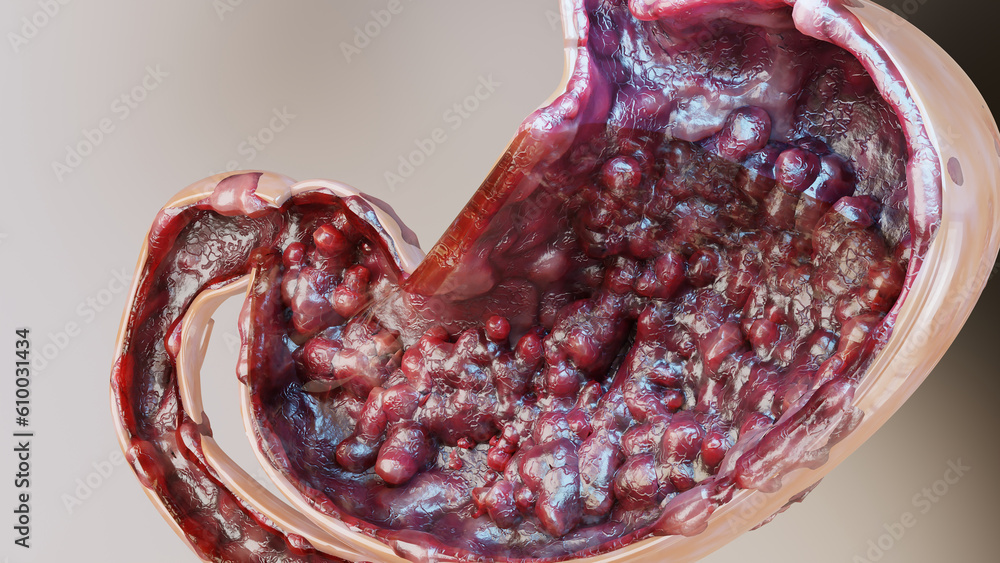 Stomach cancer. stages tumor growth in digestive system, Peptic Ulcer ...