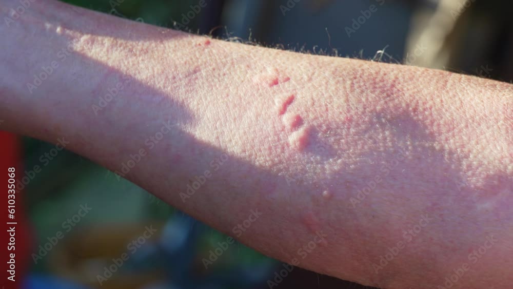 The skin's reaction to nettle is urticaria. Red, severely itchy rashes ...