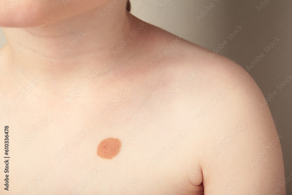 Big mole. Birthmark on body of a child. Stock Photo | Adobe Stock
