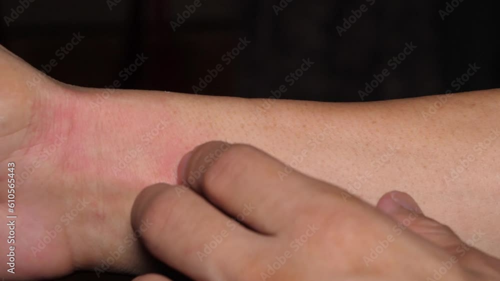 Slow motion speed closeup scene of hand scratching on arm, rash from ...