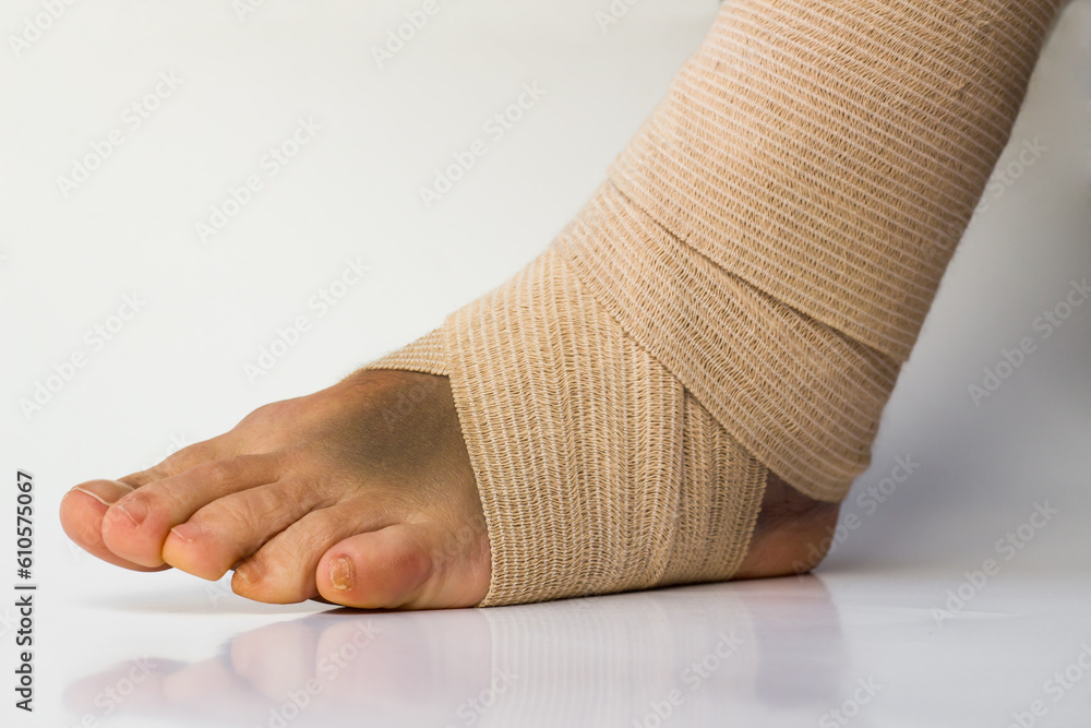 Medical bandage correctly wrapped around female sprained left ankle ...